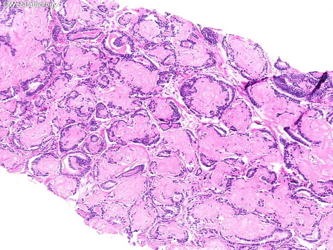 Adenocarcinoma of Prostate : Collagenous Micronodules