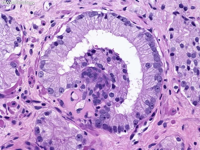 Adenocarcinoma of Prostate : Glomerulations