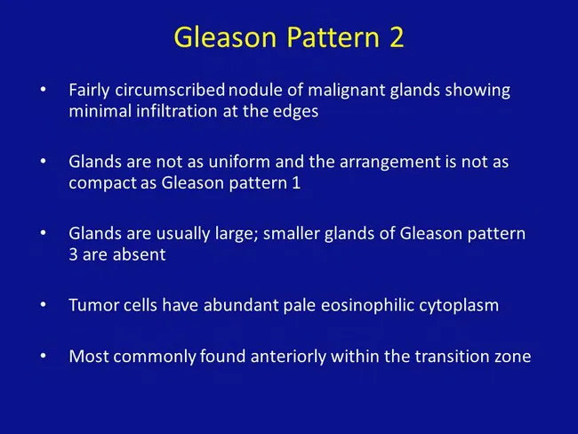 Gleason Pattern 2