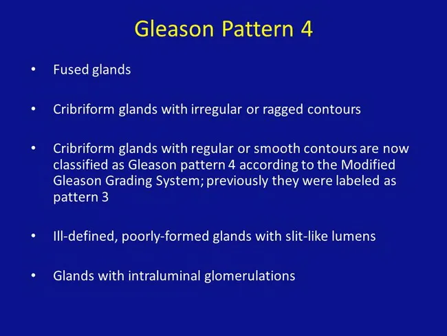Gleason Pattern 4