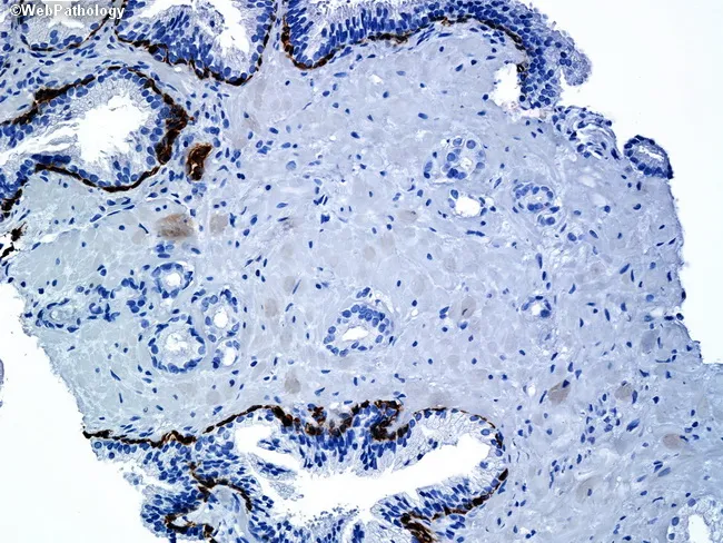 Minimal Prostate Cancer : HMWCK + p63