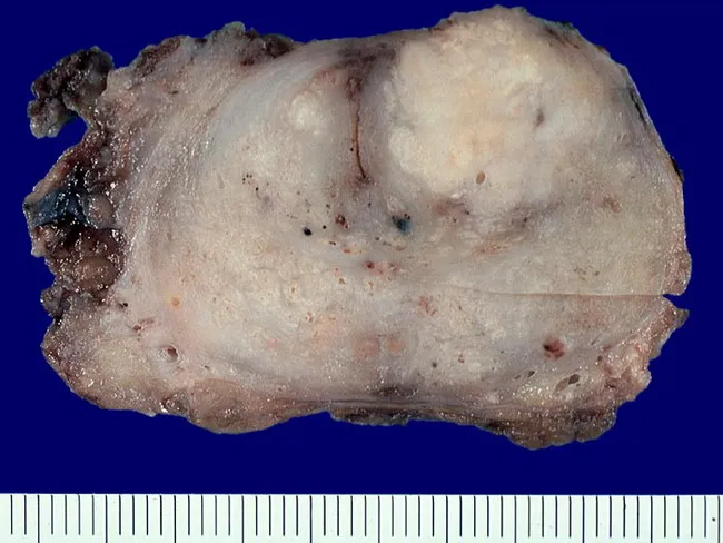 Prostate Cancer Gross Specimen