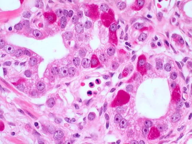 Neuroendocrine Cells in Prostate Cancer