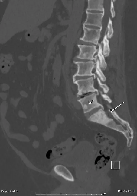 Prostate Cancer : Bone Metastases