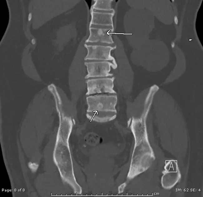 Prostate Cancer : Bone Metastases
