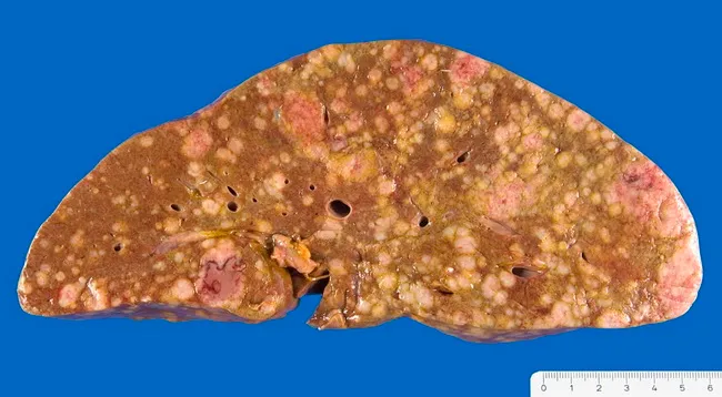 Prostate Cancer : Liver Metastases