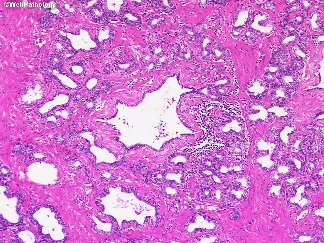 Post-atrophic Hyperplasia