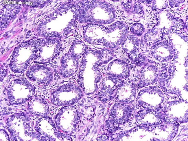 Basal Cell Hyperplasia