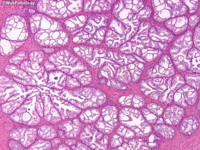 Clear Cell Cribriform Hyperplasia