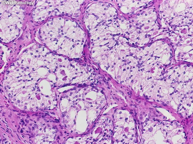 Clear Cell Cribriform Hyperplasia