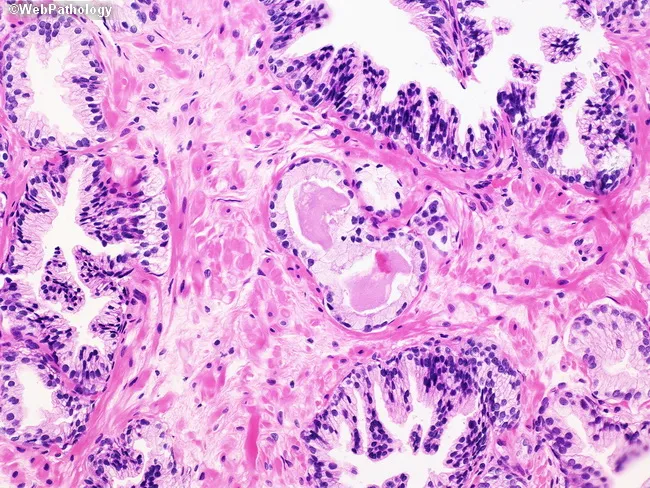 Atypical Glands in Prostate Biopsy