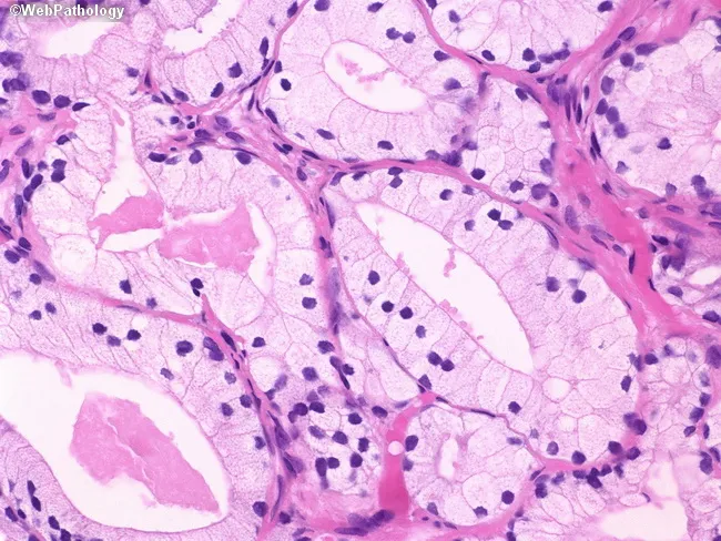 Prostate Cancer : Foamy Gland Type