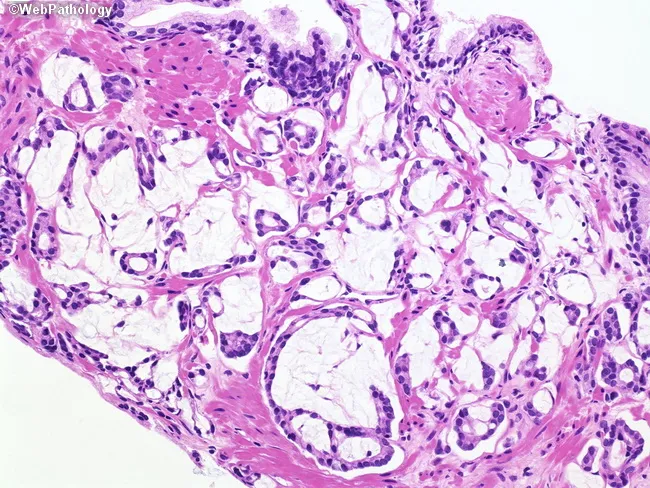 Prostate Cancer : Mucinous Type