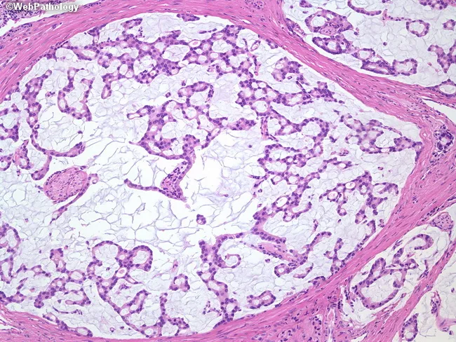 Prostate Cancer : Mucinous Type