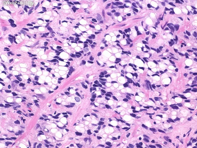 Prostate Cancer : Signet Ring-Cell Type