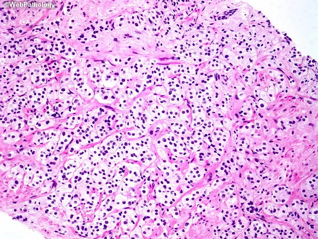 Prostate Cancer : Post-Androgen Deprivation Therapy