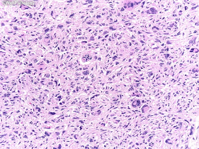 Stromal Sarcoma of Prostate