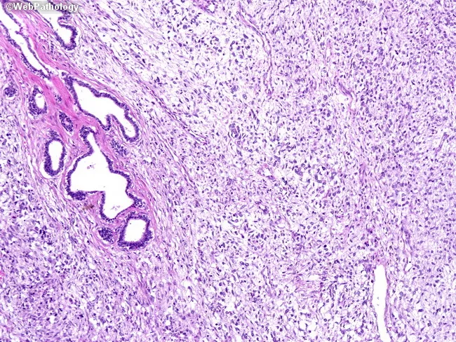 Embryonal Rhabdomyosarcoma
