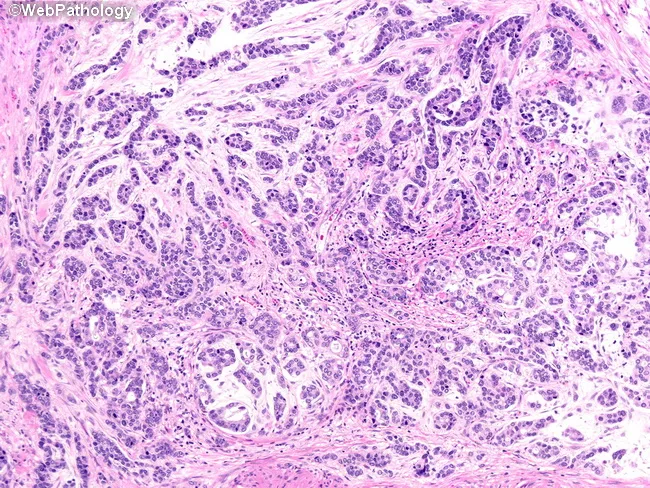 Basal Cell Carcinoma of Prostate