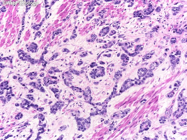 Basal Cell Carcinoma of Prostate