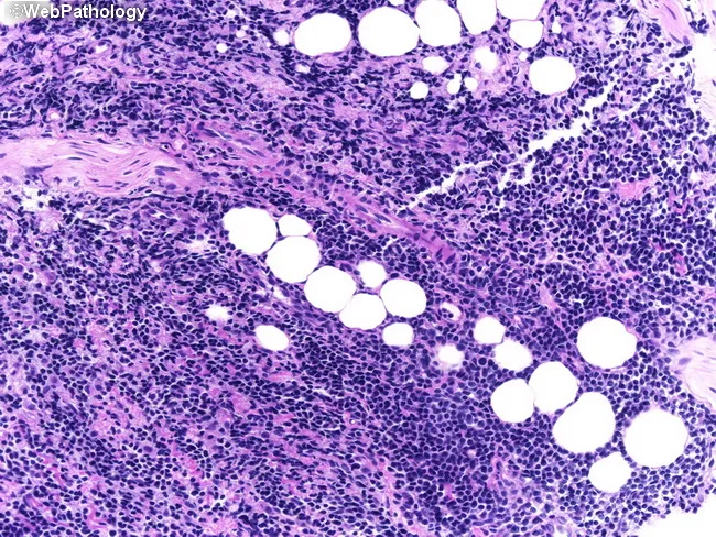 Lymphoma in Prostate