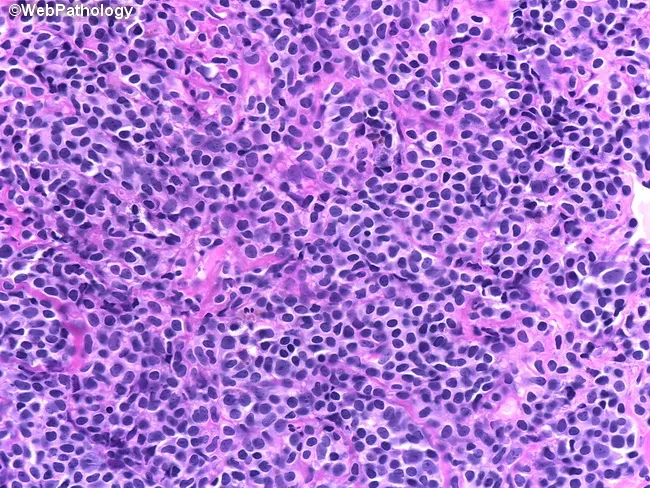 Lymphoma in Prostate