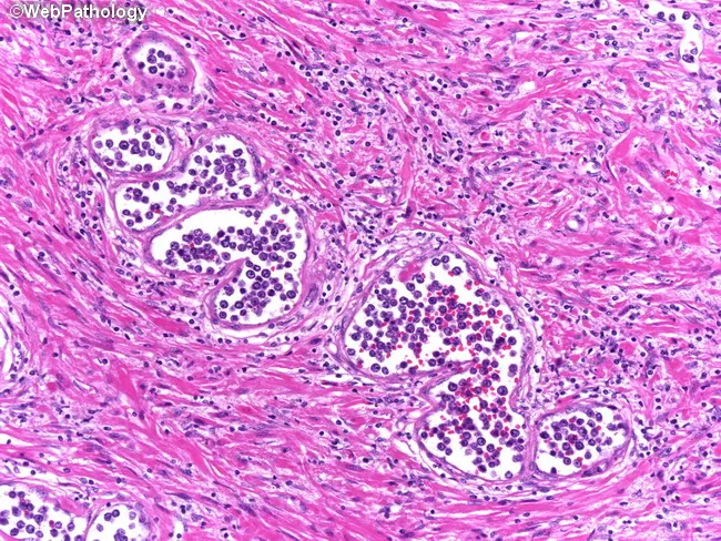 Intravascular Lymphoma in Prostate