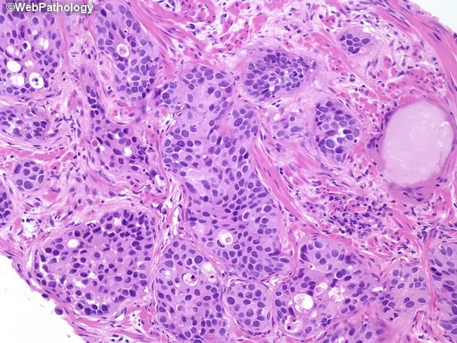 Urothelial Carcinoma in Prostate
