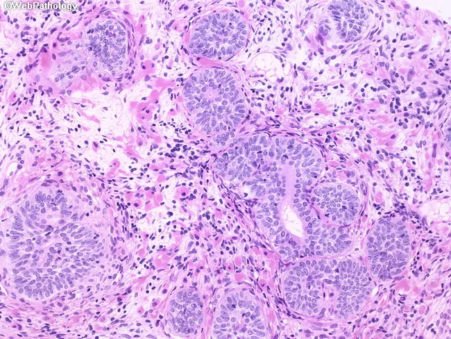 basal cell layer prostate