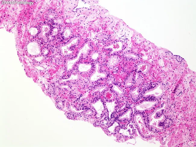 Adenosis (Atypical Adenomatous Hyperplasia )