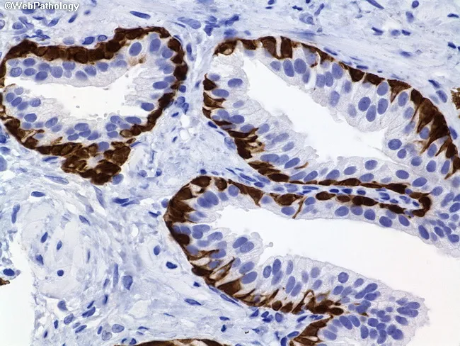 p63 in Prostate