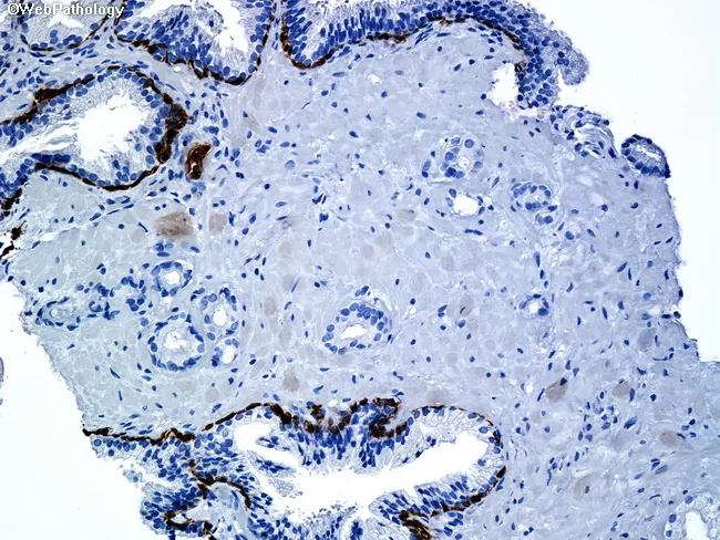 HMWCK + p63 in Prostate Cancer