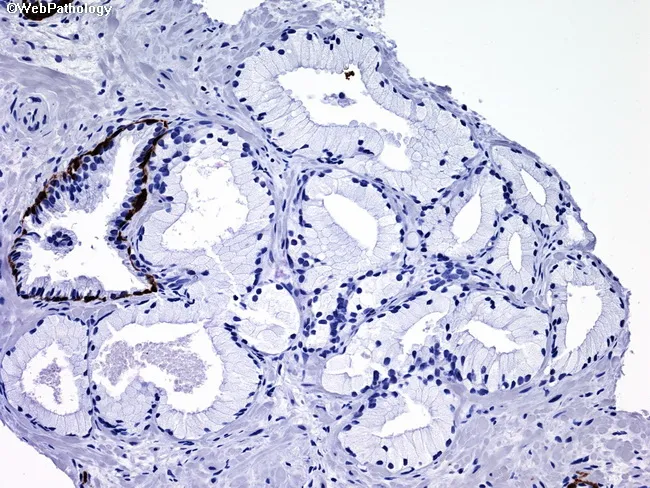 HMWCK + p63 in Prostate Cancer