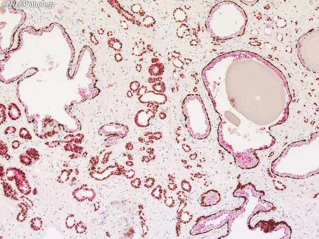 Aberrant p63 expression in Prostate Cancer