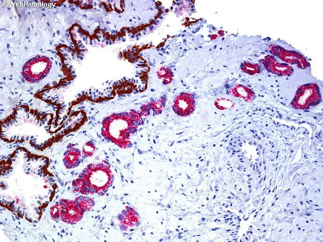 PIN-4 Cocktail in Prostate Cancer