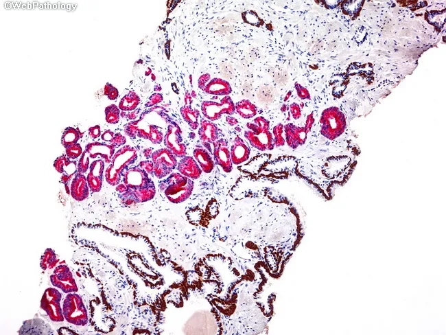 PIN-4 Cocktail in Prostate Cancer