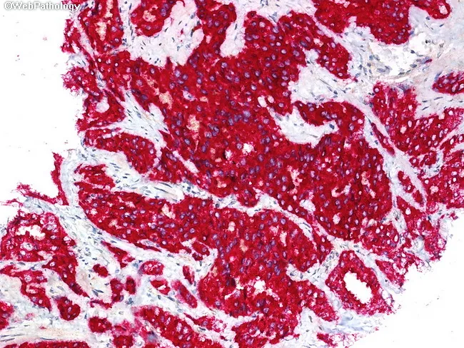 PIN-4 Cocktail in Prostate Cancer