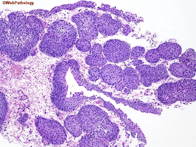 Normal Urothelium : Brunn Nests