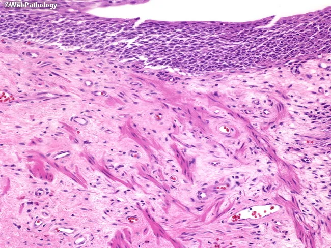 Benign Urothelium : Lamina Propria