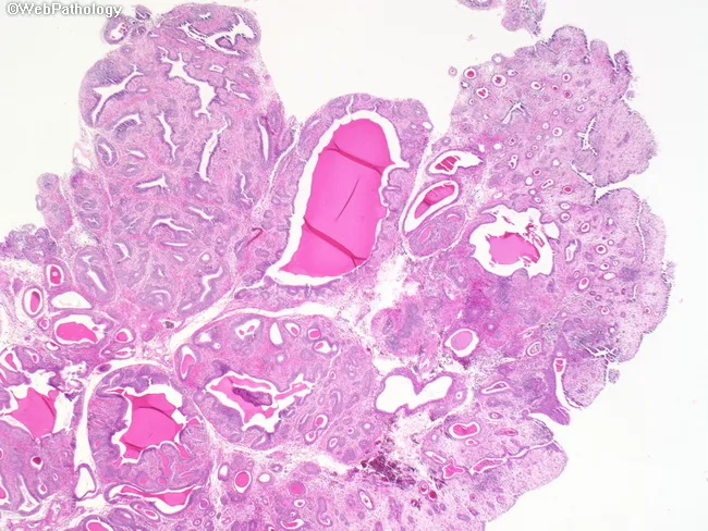 Cystitis Cystica & Cystitis Glandularis