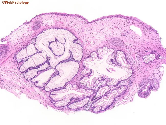 Intestinal Metaplasia