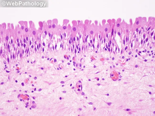 Bladder Diverticulum : Clinical Presentation