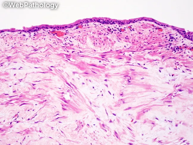 bladder diverticulum