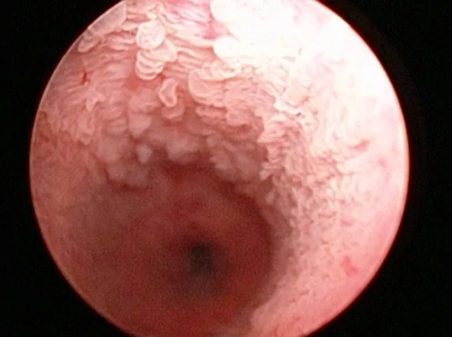 urethral polyp