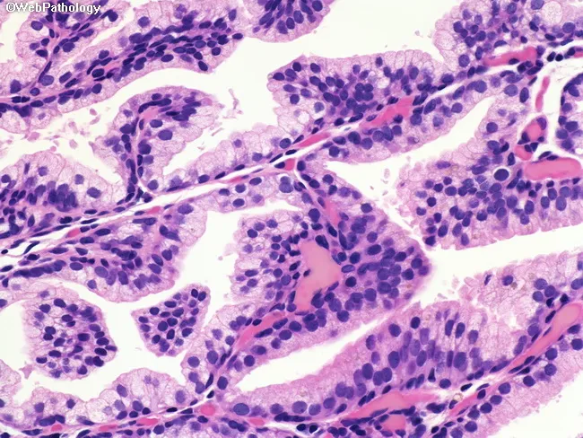 Prostatic Urethral Polyp