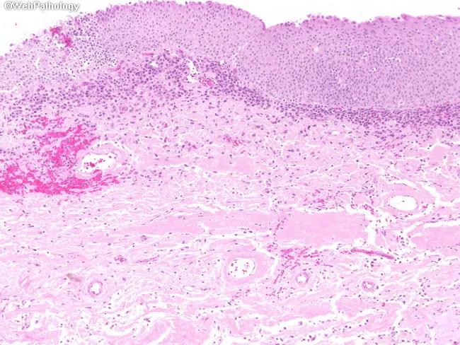 Amyloidosis of Bladder