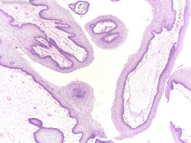 Fibroepithelial Polyp