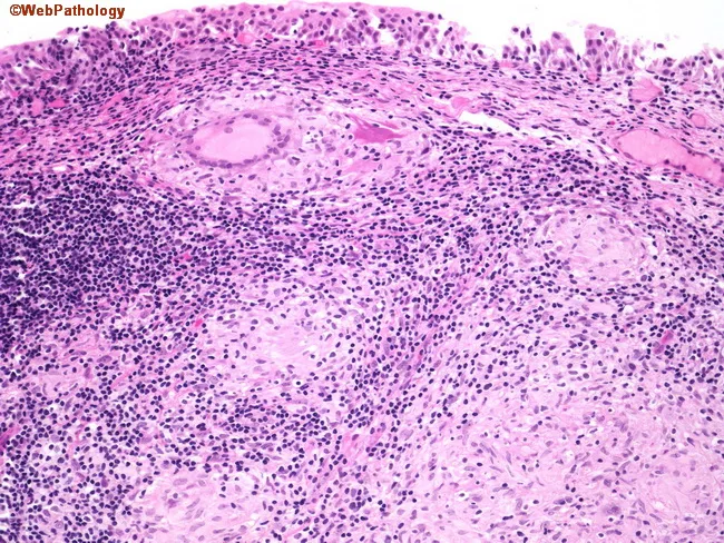 Granulomatous Cystitis : Post-BCG