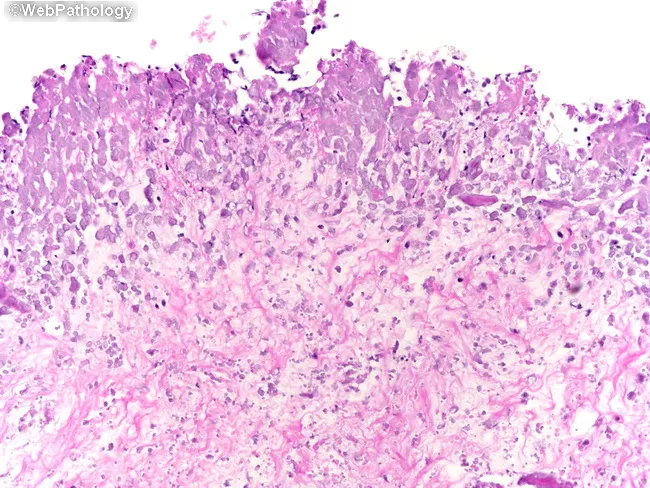 Encrusted Cystitis