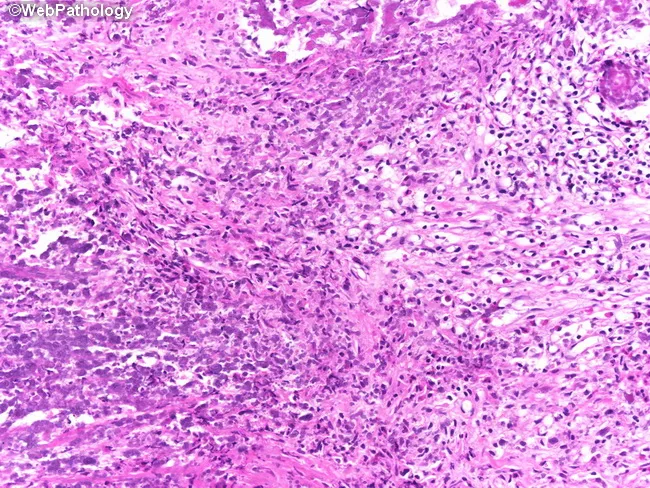 Encrusted Cystitis